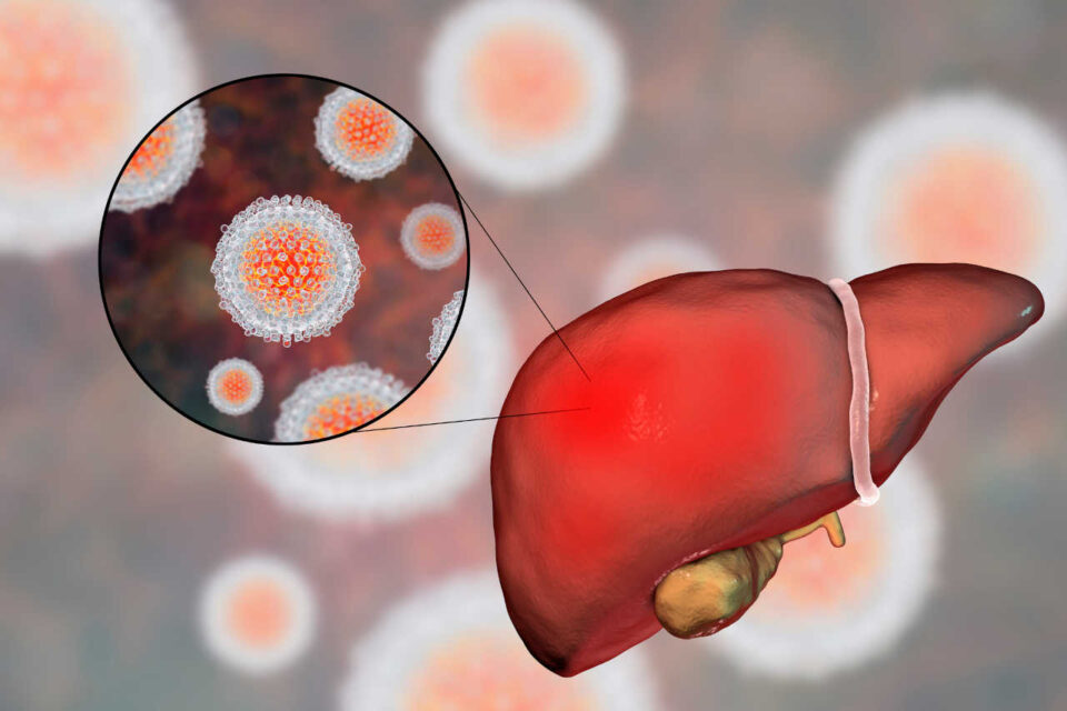 Mavyret: A Highly Effective Treatment for Chronic Hepatitis C